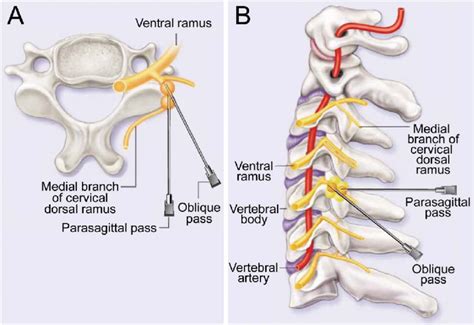 Cervical Medial Branch Block