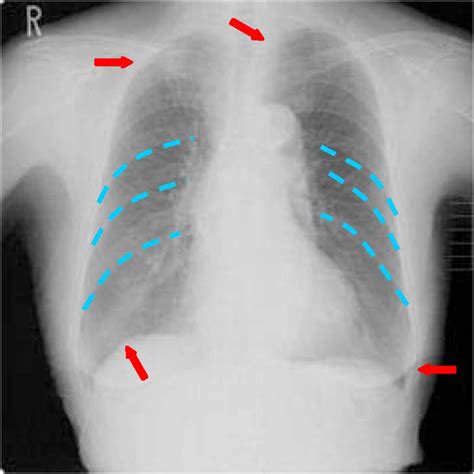 What Is Lung Fields Are Clear At Victor Fox Blog