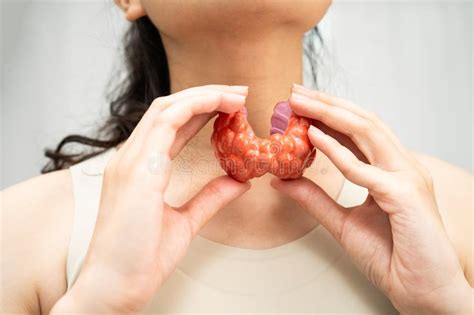 Hyperthyroidism Overactive Thyroid Thyroid Lymphoma Asian Woman With Thyroid Gland Human