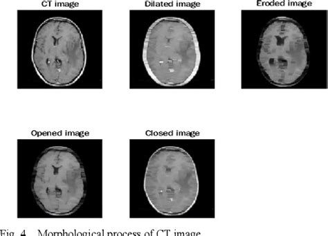Figure 4 From Detection Of Human Brain Tumor By Medical Image Processing And Pca Based Image