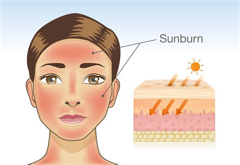 Sunburn Publications News And Products About Sunburn In Credoweb