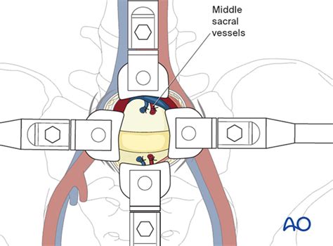 Retroperitoneal Approach For Anterior Lumbar Interbody Fusion Alif