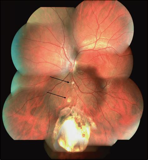 Fundus Photograph Of Choroidal Coloboma I Small Coloboma Restricted