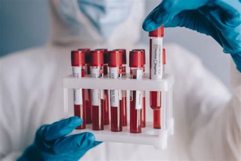 Pemeriksaan Hiv Rna Di Klinik Lina Lica Hdmall