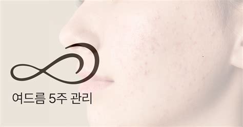 시술소개 붉은 여드름 5주 프로그램｜정밀 시술 특화 세린의원