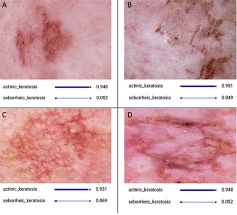 Artificial Intelligence Based Distinction Of Actinic Keratosis And