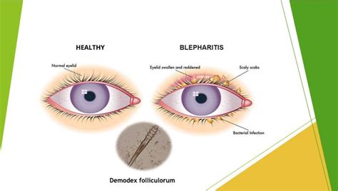 Tina Mehrmanesh On Linkedin Demodex Folliculorum And Blepharitis One Of The Two Types Of Demodex…