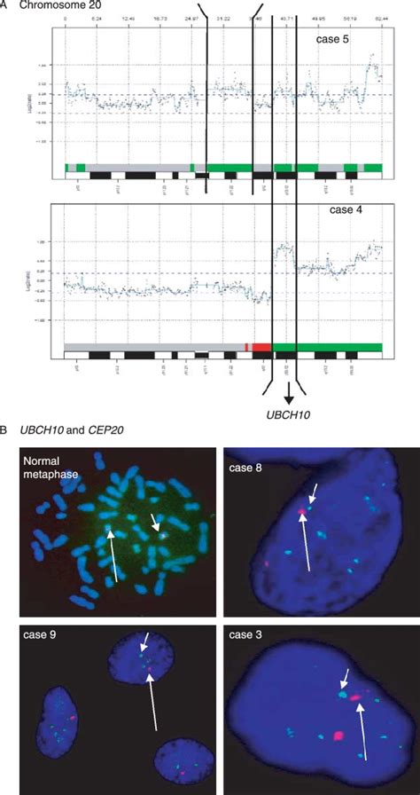 A Array Cgh Profiles Of Chromosome 20 For Case 5 Upper Showing Download Scientific Diagram