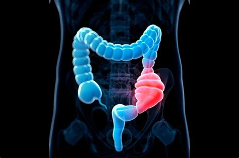 Best Hospital For Colectomy Surgery In India Medisuggest