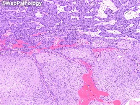 Inverted Urothelial Papilloma Microscopic Features