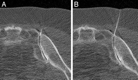 Sacroiliac Joint Ct Scan