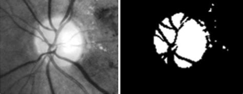 Left Preprocessed Optic Disc And Right Segmented Optic Disc