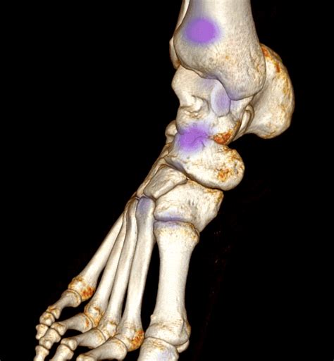 Navicular Fracture The Navicular Bone