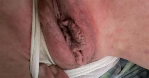 Weird Rash Genital Issue And Joint Issues