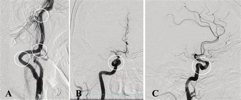 Right Internal Carotid Angiography Shows The Right Middle Cerebral