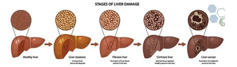 A Strategy For Hepatitis Diagnosis By Using Spherical Q Linear Diophantine Fuzzy Dombi
