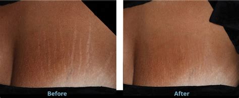 Stretch Mark Laser Removal Before And After Results [real Cases