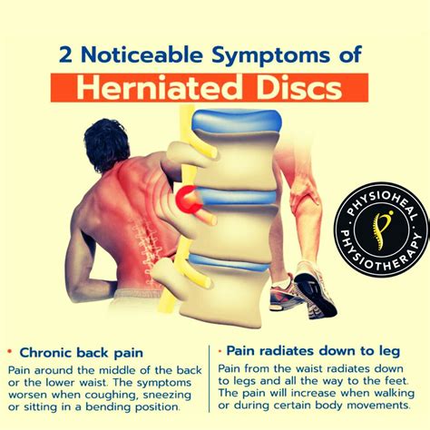 Disc Herniation Also Known As A Slipped Or Bulging Disc Occurs When