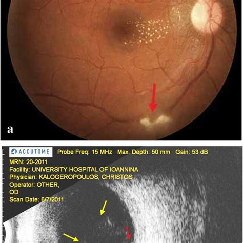 A Active Toxoplasmic Retinitis Red Arrow With A Slightly Hazed Download Scientific Diagram