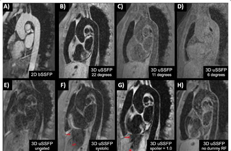 pulse sequence comparisons in a healthy subject a 2d bssfp b 3d