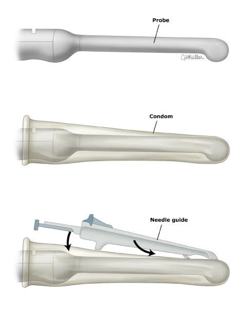 Prostate Biopsy Urology Clinic In Selangor Malaysia