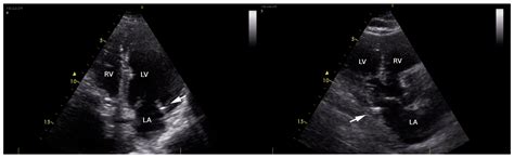 Mitral Annular Calcification And Thromboembolic Risk