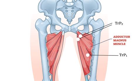 Acupuncture For Adductor Magnus Pain Aca Acupuncture And Wellness