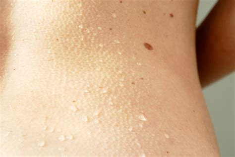 Raised Skin Bumps Pictures Types Causes And Treatment 42 Off