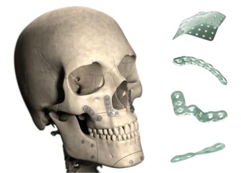 Biodegradable Implants Transform Dentistry And Surgery