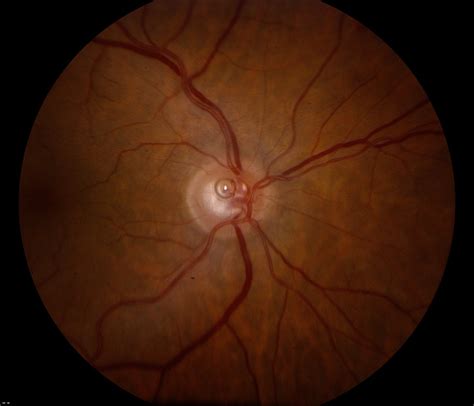 Check Your Blind Spot Perfluoropropane Gas In The Optic Nerve Head