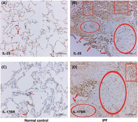 Expression Levels Of Il‐25il‐17br In Ipf Lungs Shown Is Download