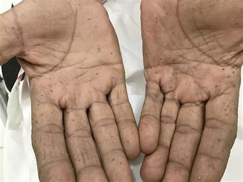 Punctate Palmoplantar Keratoderma A Case Report Of Type 1 Buschke Fischer Brauer Disease