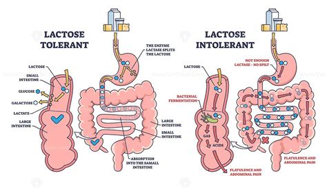 Lactose Intolerance And Tolerance Medical Process Differences Outline Diagram Lactose