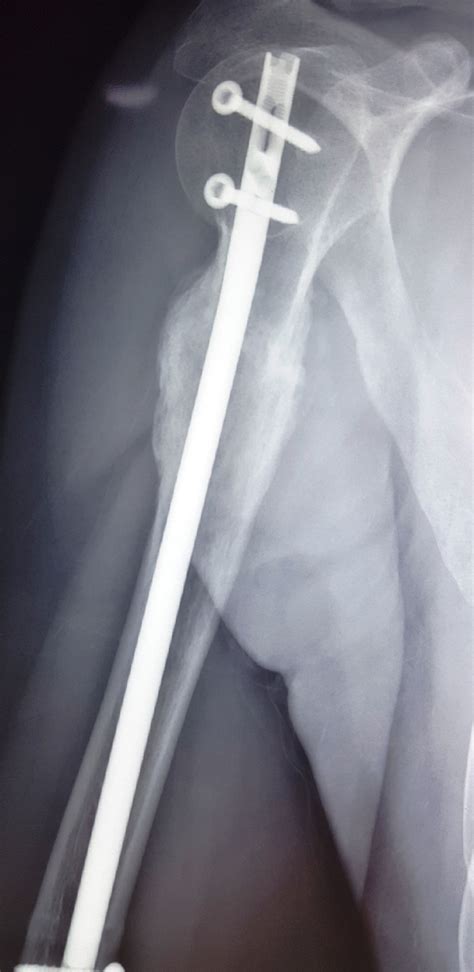 How Common Is To Achieve Union After Pathological Fracture Of A Long Bone ResearchGate