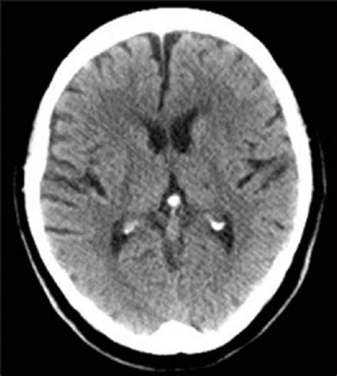 Meperidine Induced Seizure In An Adult Patient With Lung Lesions Pmc