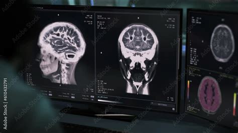X Ray Scanner Equipment Interface Imaging The Patients Brain Medical