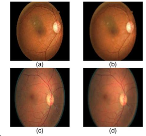 Figure 1 From Using A Machine Learning Algorithm And Fundus Images To Treat Diabetic Retinopathy