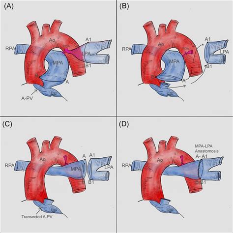 Intraoperative Photograph Showing The Main Pulmonary Arteryleft