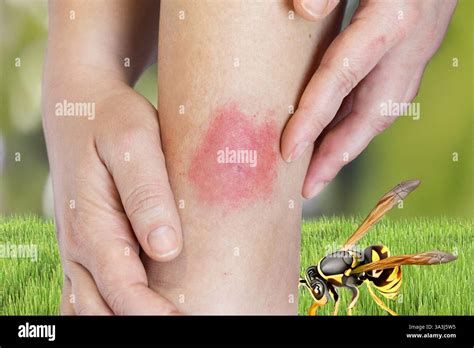 Allergic Reaction To An Insect Bite Allergy To Wasp And Mosquito Bites