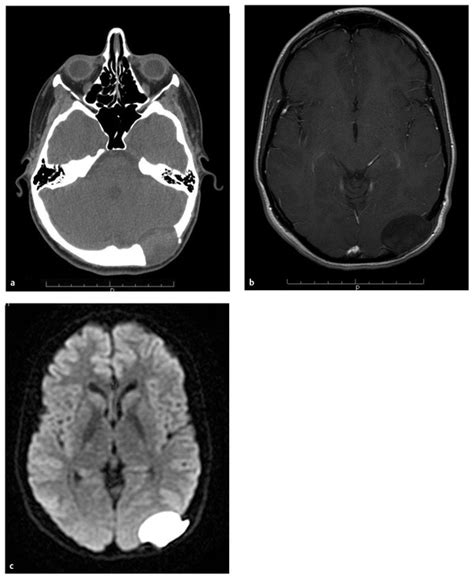 Scalp And Skull Neoplasms Neupsy Key