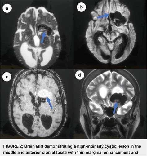 Figure 2 From An Atypical Case Of Intracranial Dermoid Cyst In An Adult Female A Case Report