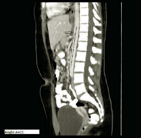 Sagittal Reformatted Multislice Ct With Oral And Intravenous Contrast
