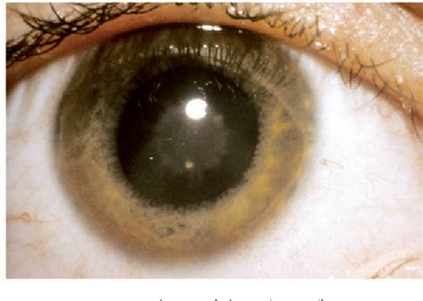 Sunflower Color Eyes Discover The Radiant Beauty Of Golden Hued Eyes
