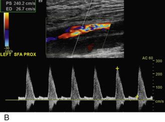 Ultrasound Assessment Of Lower Extremity Arteries Radiology Key