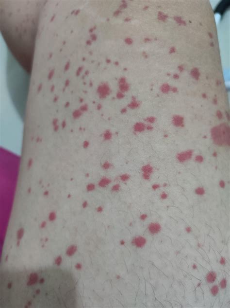 Is This Urticaria R Urticaria
