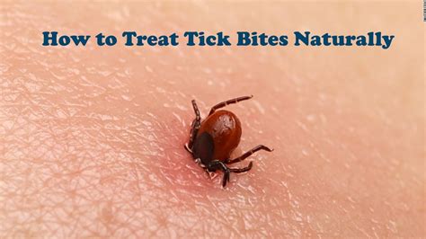 Lyme Disease Tick Bite Human At Kathy Carter Blog