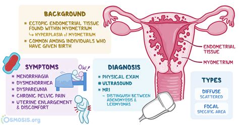 Adenomyosis What Is It Causes Diagnosis Treatment And More Osmosis