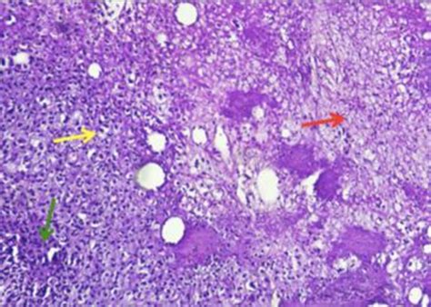 histopathological reading result after he staining from the slide we