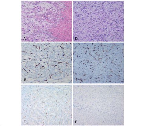 Primary Cholangiocarcinoma And Metastatic Pancreatic Ductal Download Scientific Diagram