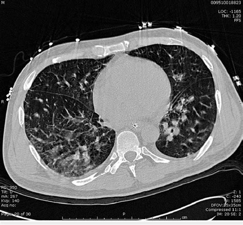 Patchy Pulmonary Noninfectious Infiltrates Download Scientific Diagram